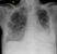 Pleuritis calcarea - Wissen+ | X-Ray Webinar